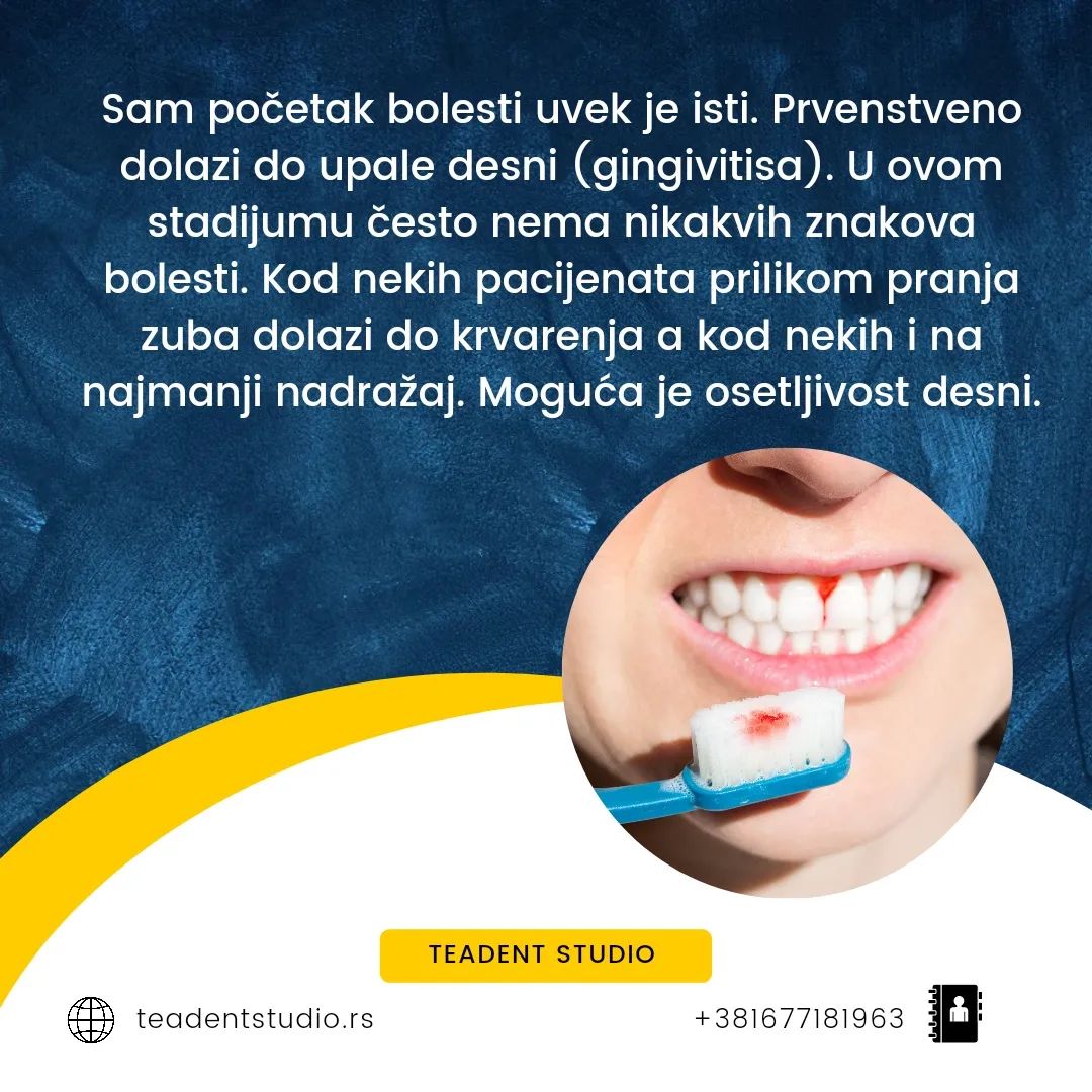 Parodontopatija | Novosti | TeaDent Studio